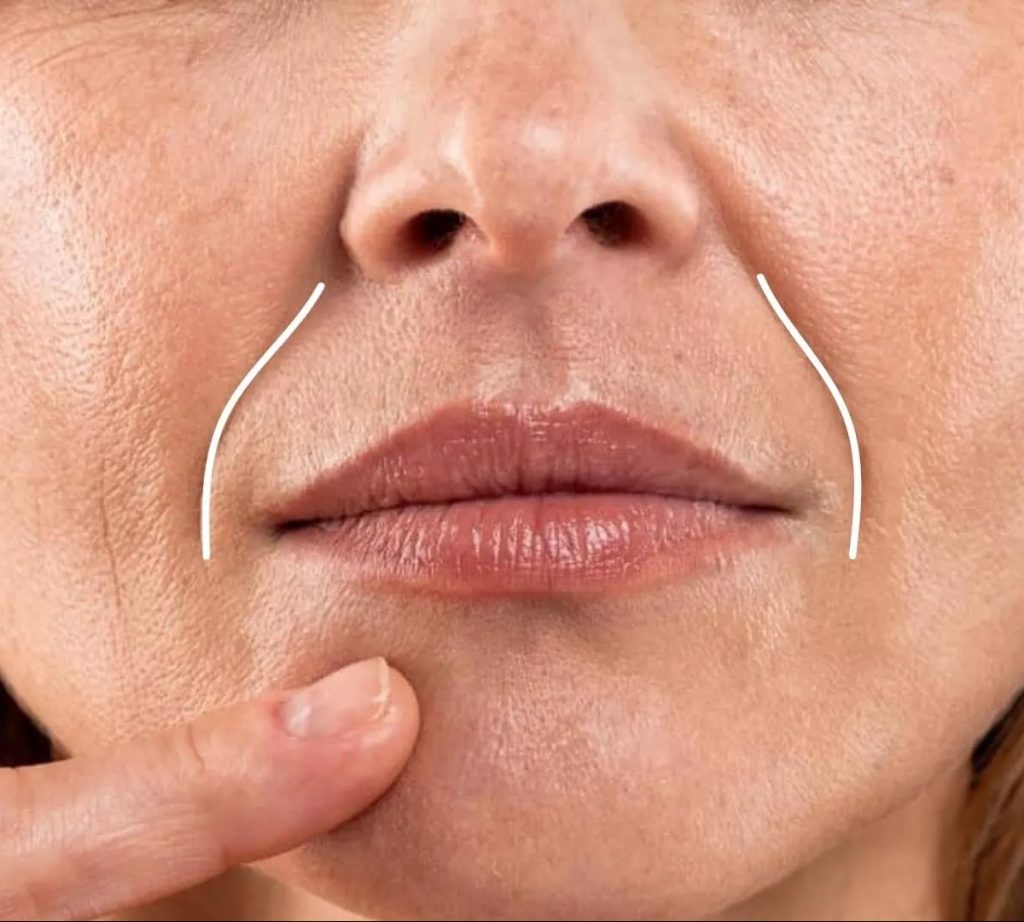 Nasolabial Filler
